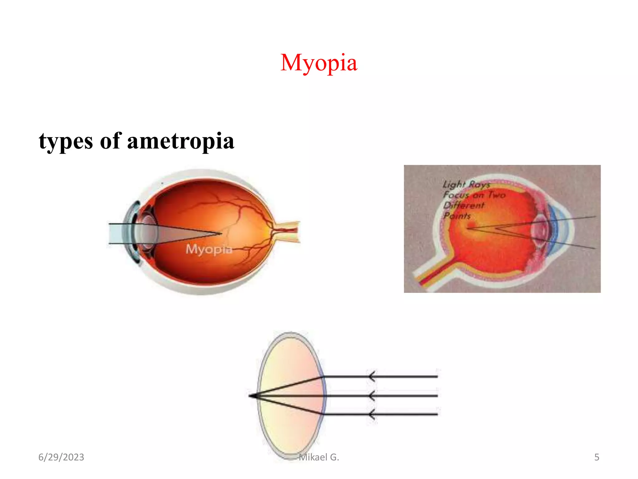 Myopia.pptx
