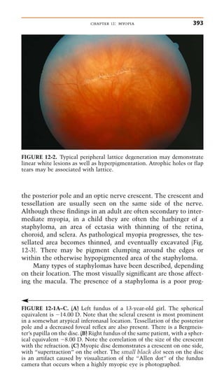 myopia.pdf