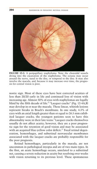 myopia.pdf