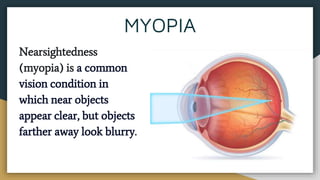 Patho Physiology of Myopia, Etiology and complications | PPT