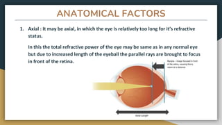 Patho Physiology of Myopia, Etiology and complications | PPTX