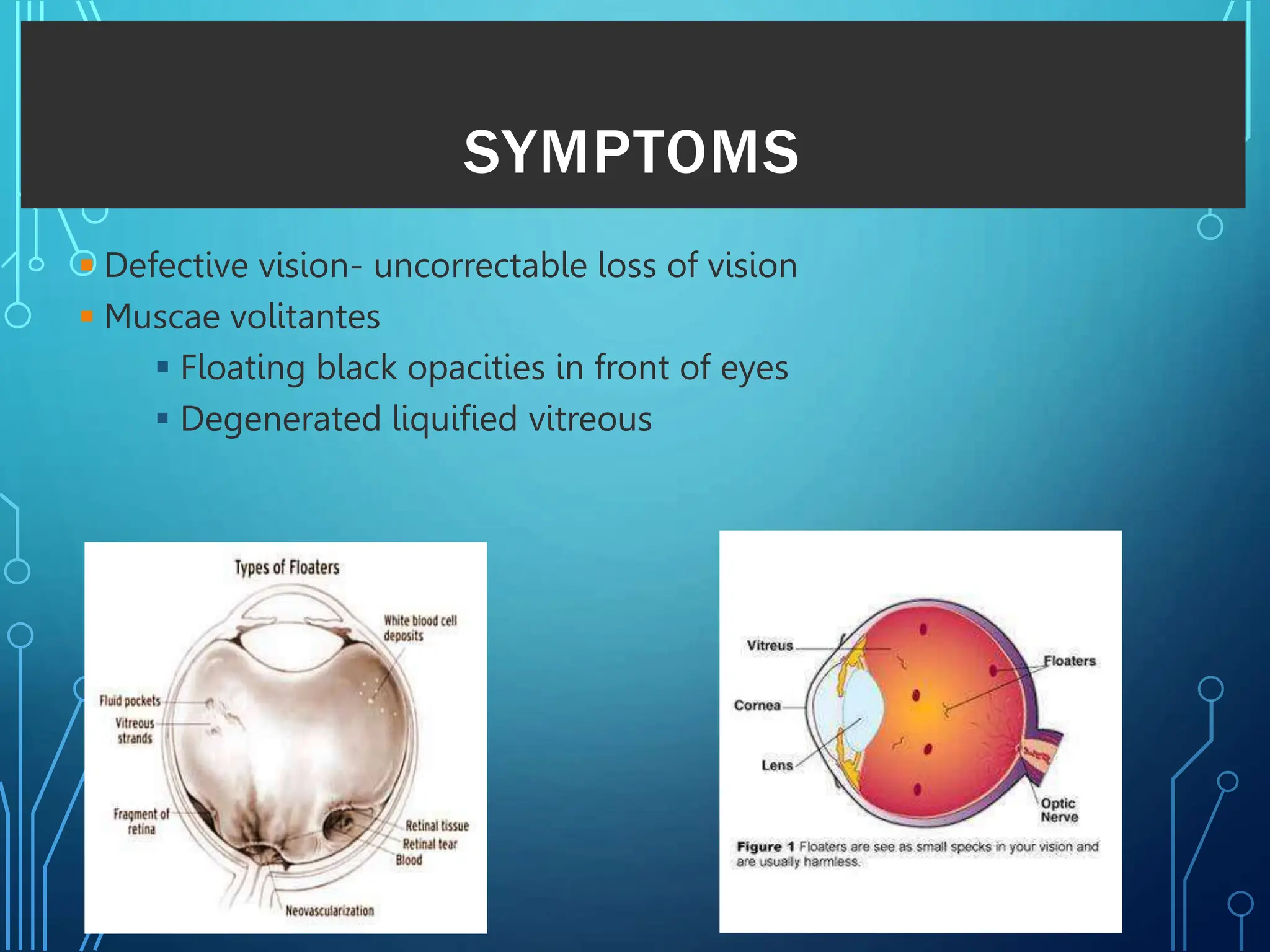 MYOPIA , basics , causes , types and treatment | PPTX