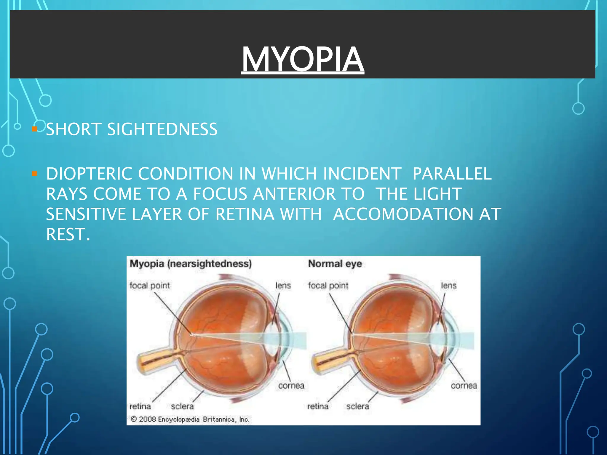 MYOPIA , basics , causes , types and treatment | PPTX