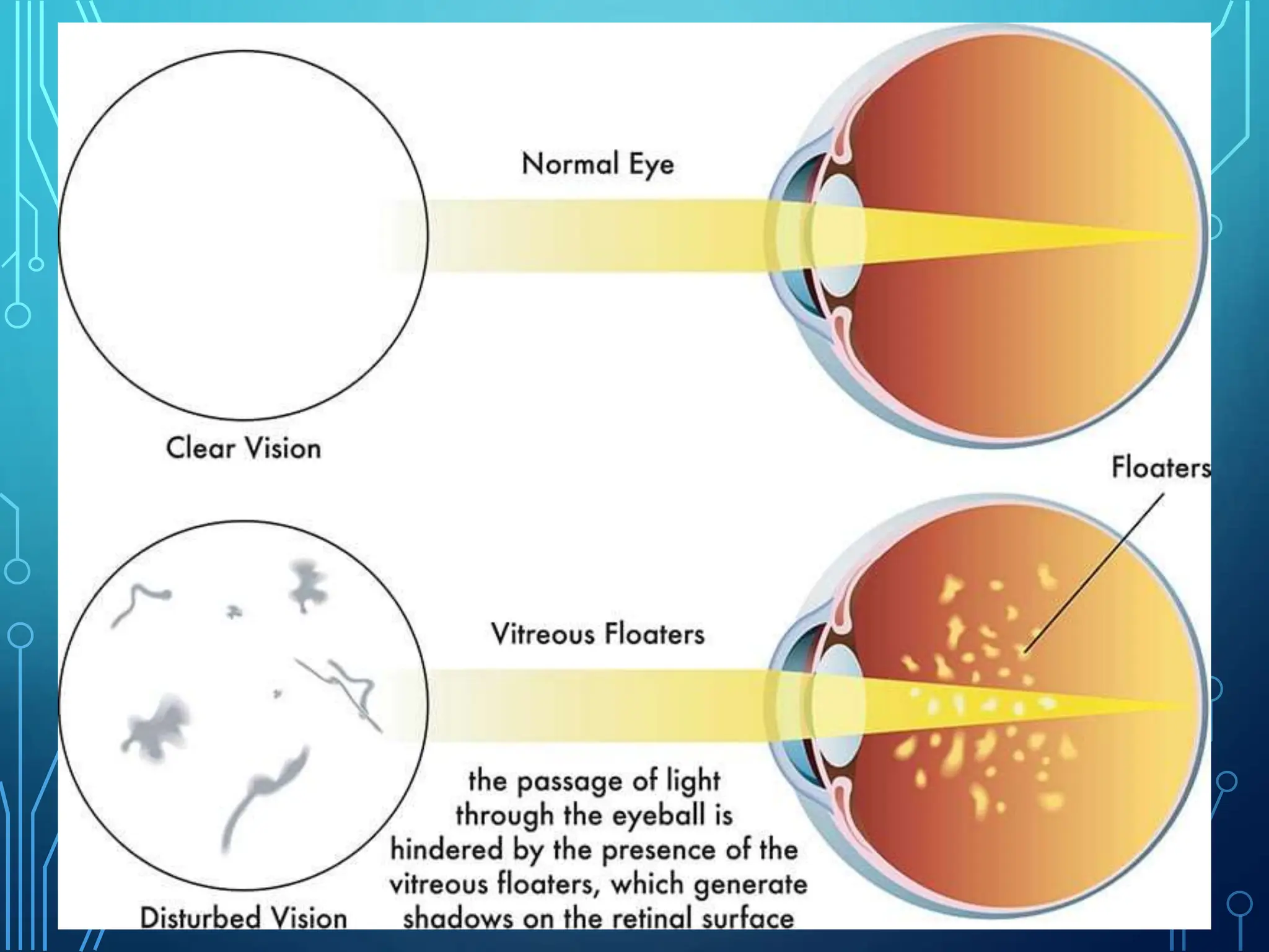 MYOPIA , basics , causes , types and treatment | PPTX