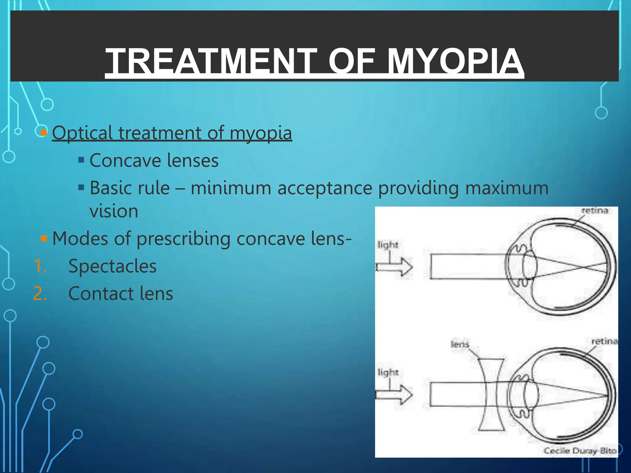 MYOPIA , basics , causes , types and treatment | PPTX
