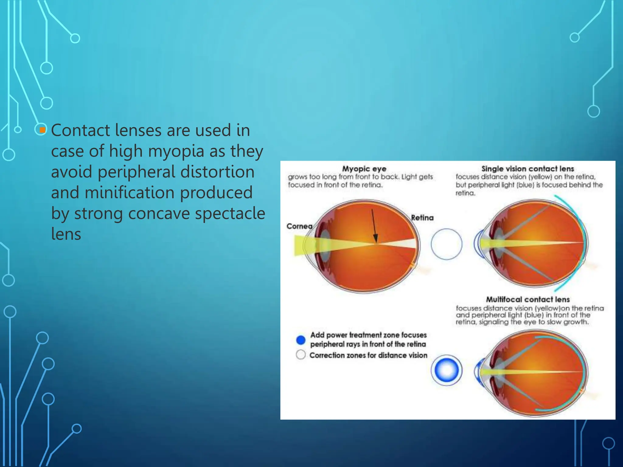 MYOPIA , basics , causes , types and treatment | PPTX