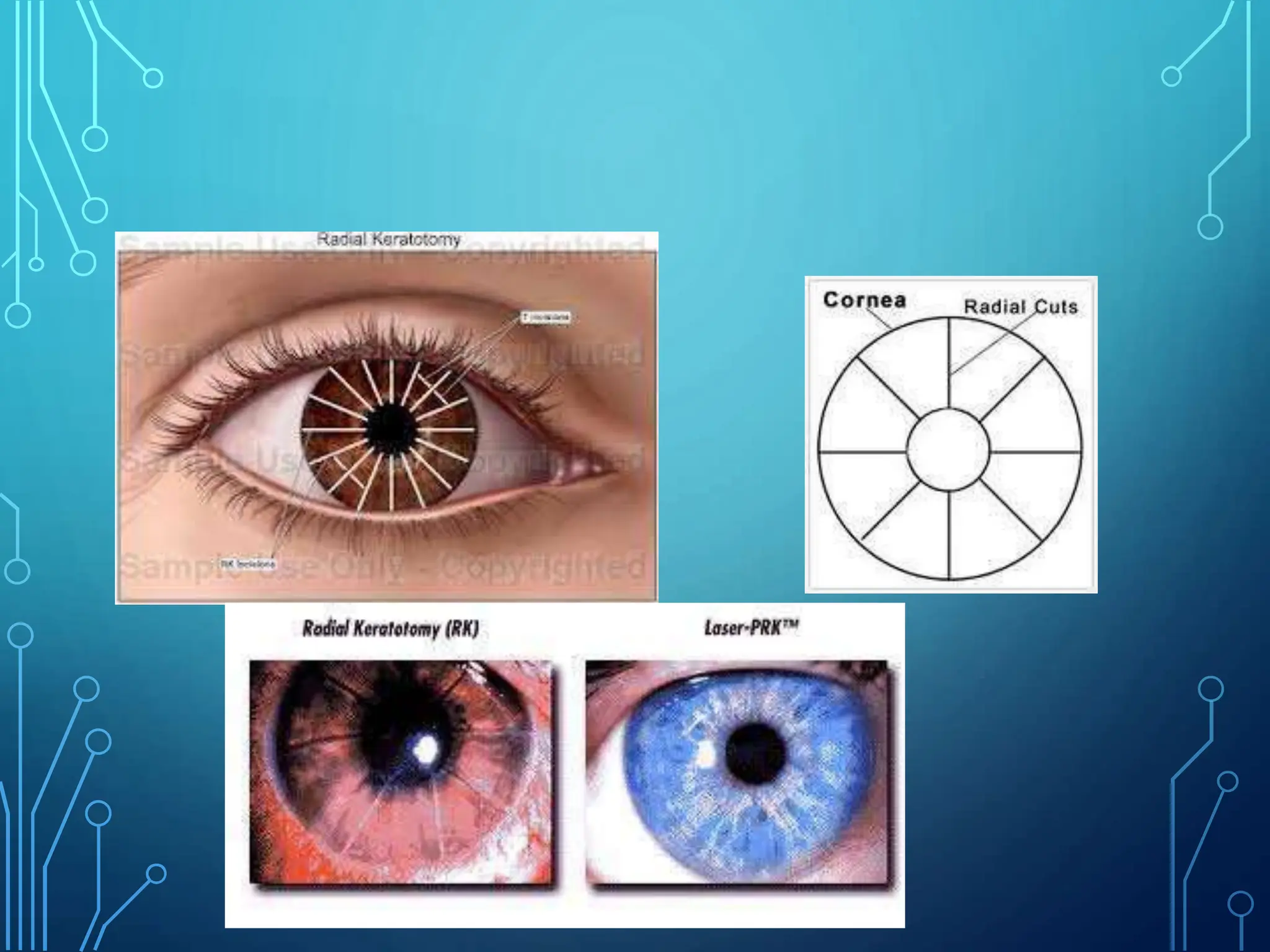 MYOPIA , basics , causes , types and treatment | PPTX