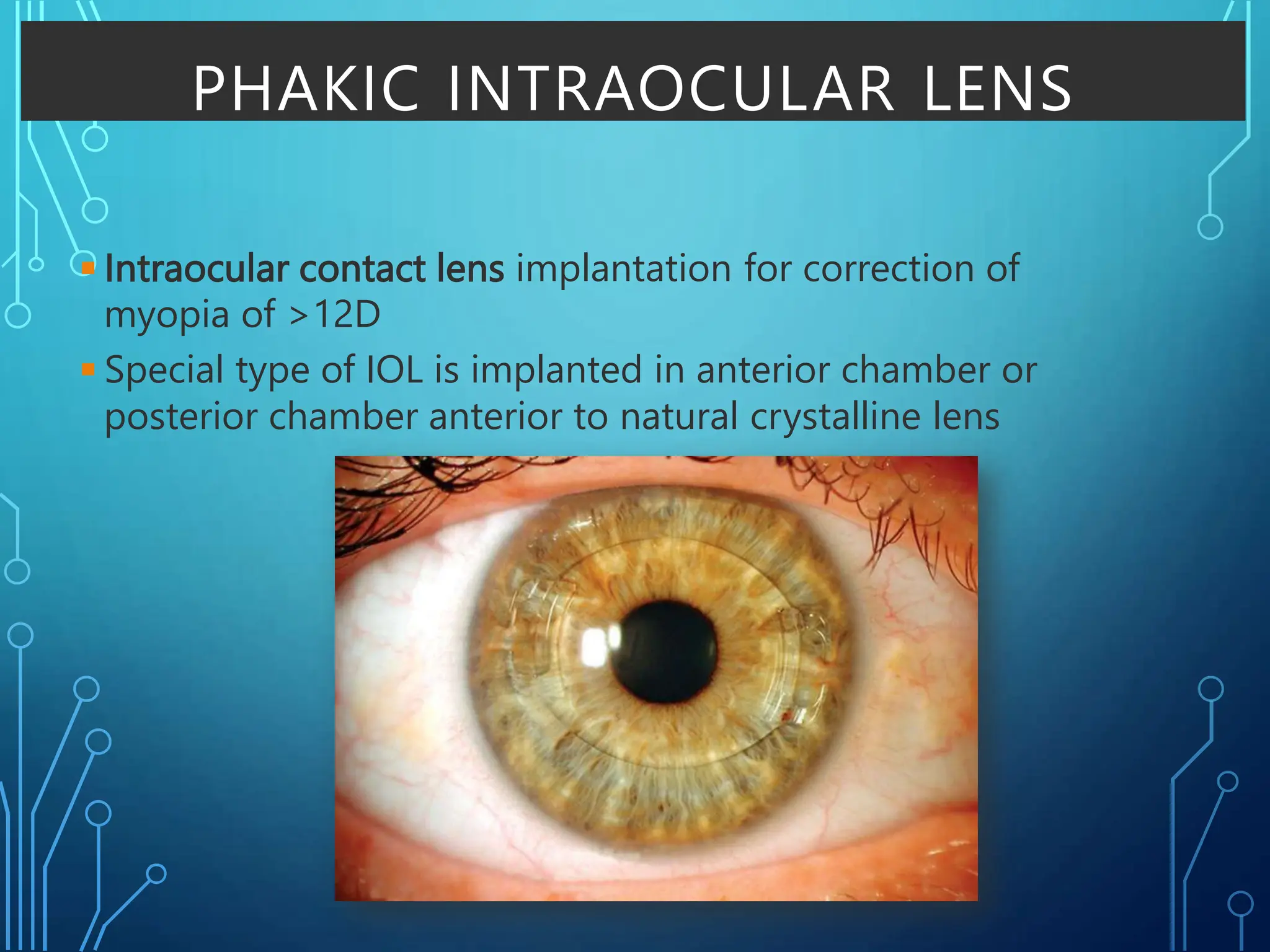 MYOPIA , basics , causes , types and treatment | PPTX