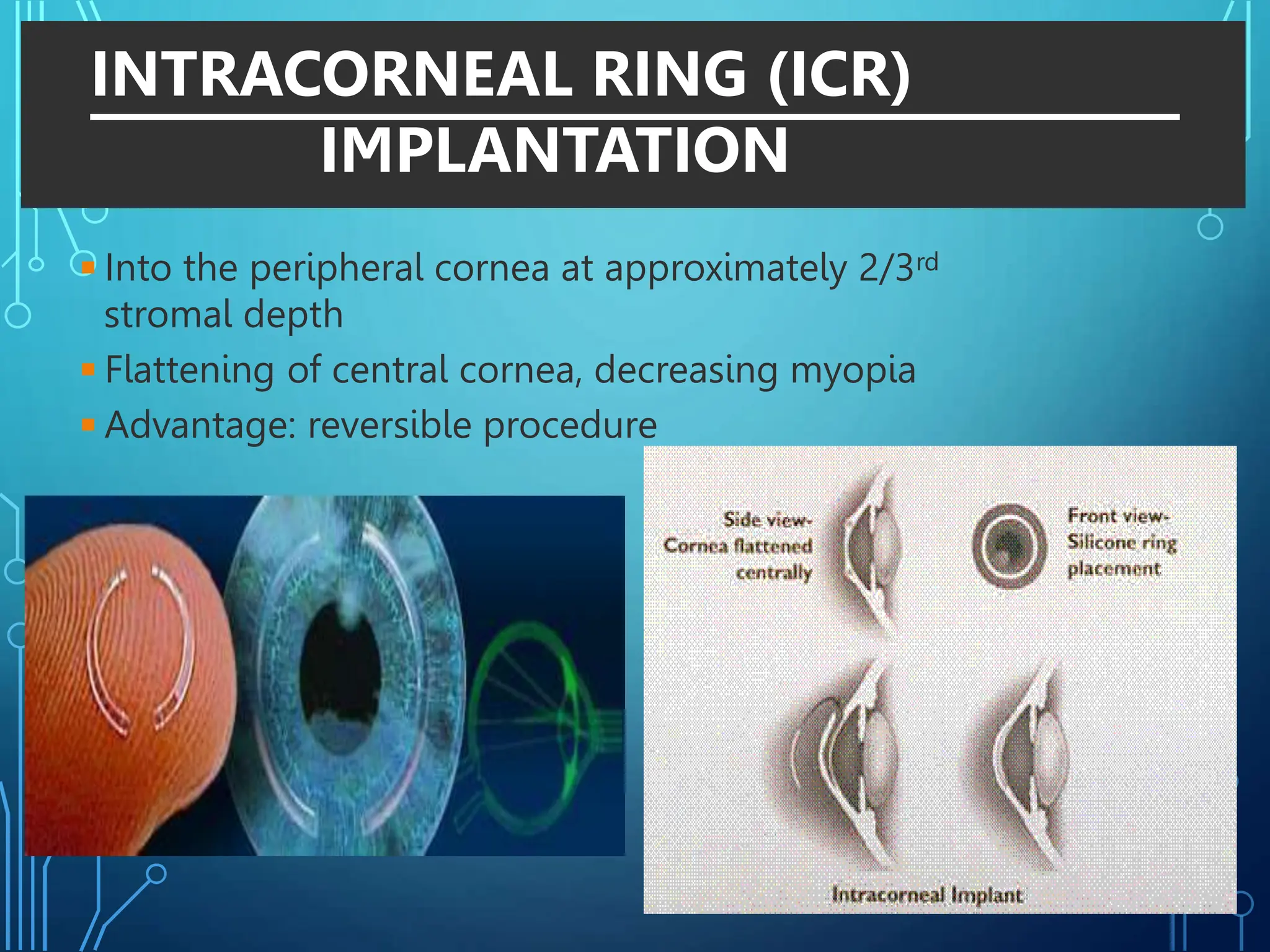 MYOPIA , basics , causes , types and treatment | PPTX