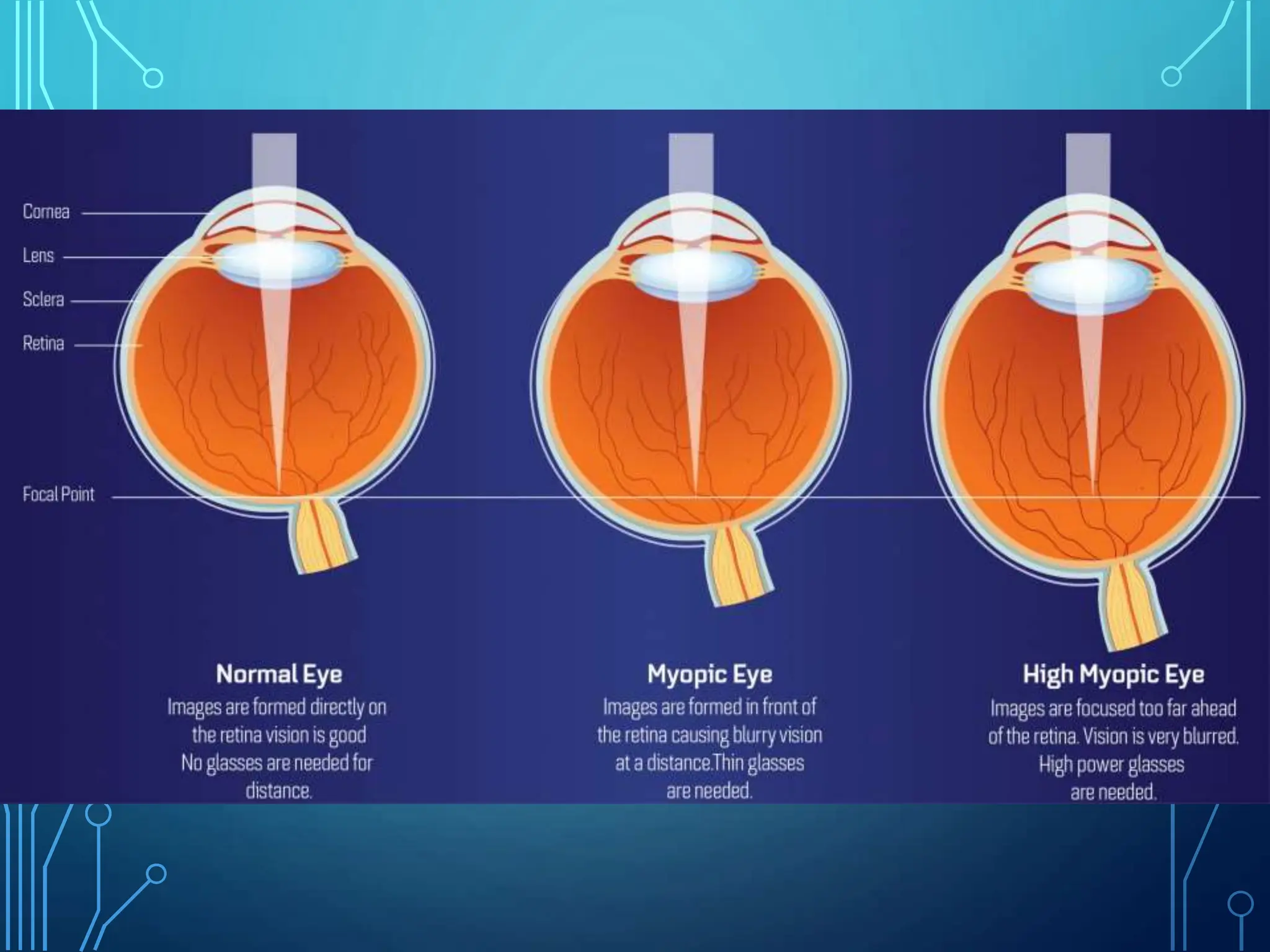 MYOPIA , basics , causes , types and treatment | PPTX