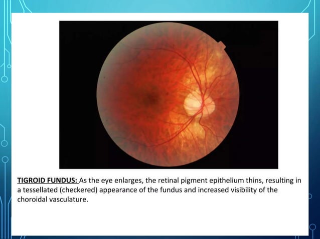 MYOPIA , basics , causes , types and treatment | PPTX