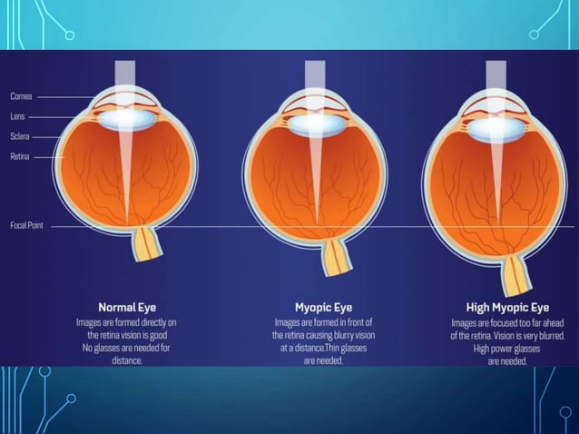 MYOPIA , basics , causes , types and treatment | PPTX