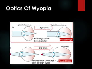 MYOPIA REFRACTIVE ERROR.pdf