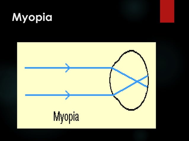 MYOPIA REFRACTIVE ERROR.pdf MYOPIA REFRACTIVE ERROR.pdf
