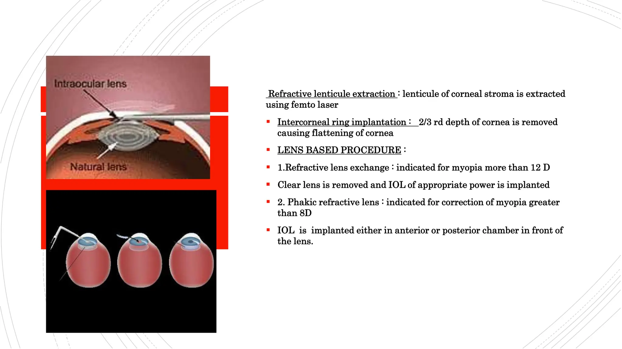 myopia of eye ophthalmology description.pptx