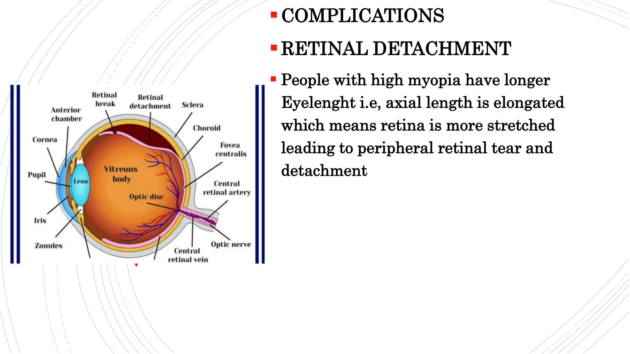 myopia of eye ophthalmology description.pptx