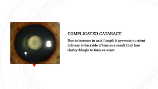 myopia of eye ophthalmology description.pptx