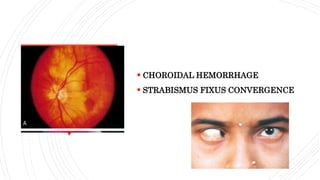 myopia of eye ophthalmology description.pptx