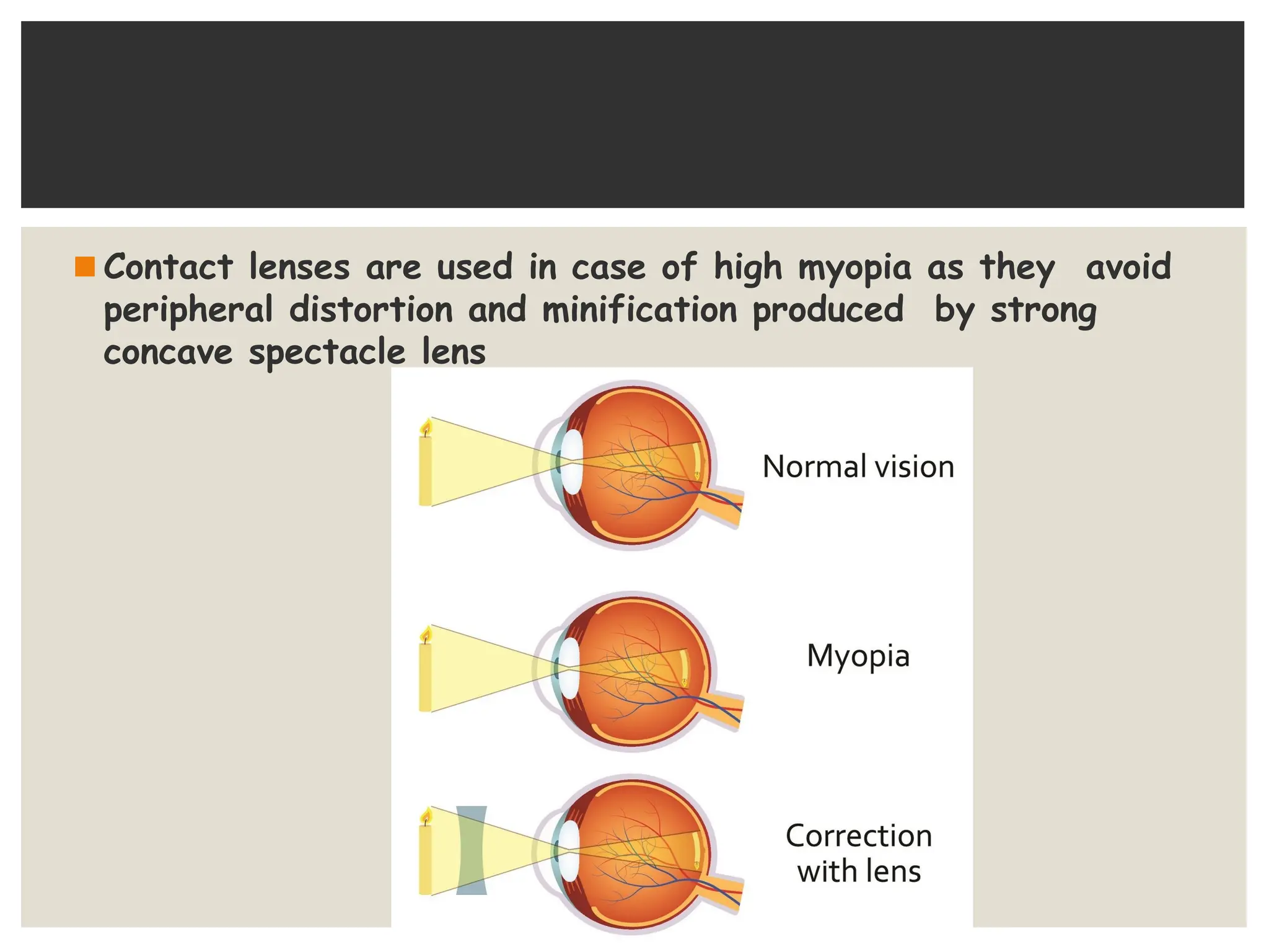 REFRACTIVE ERROR MYOPIA AND ITS MANAGEMENT.pptx