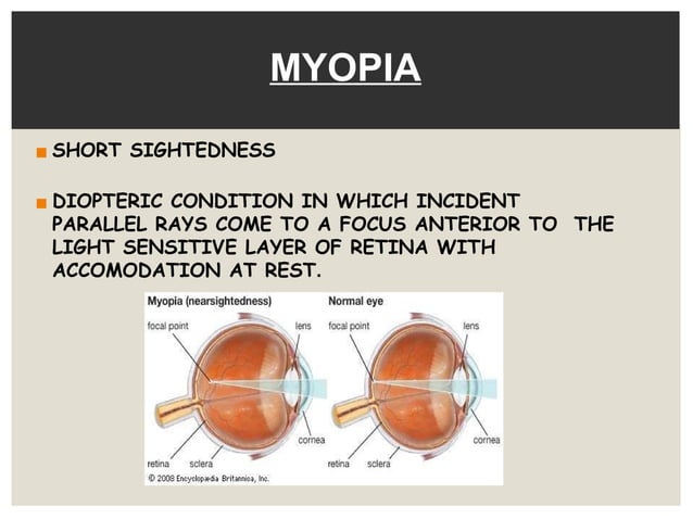 REFRACTIVE ERROR MYOPIA AND ITS MANAGEMENT.pptx