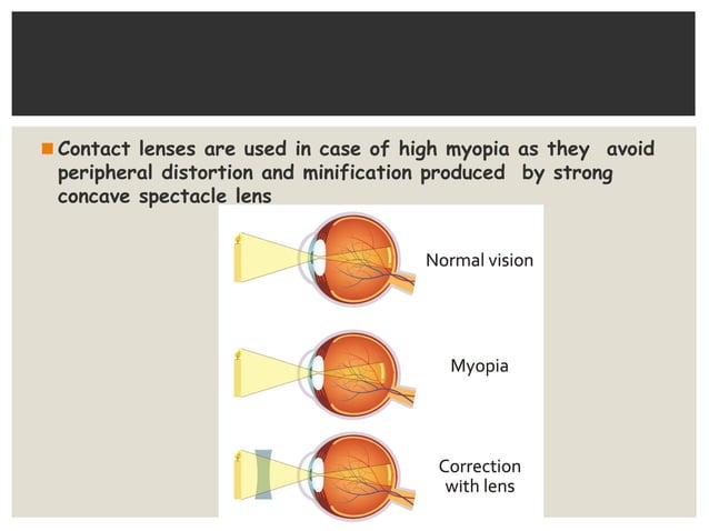 REFRACTIVE ERROR MYOPIA AND ITS MANAGEMENT.pptx
