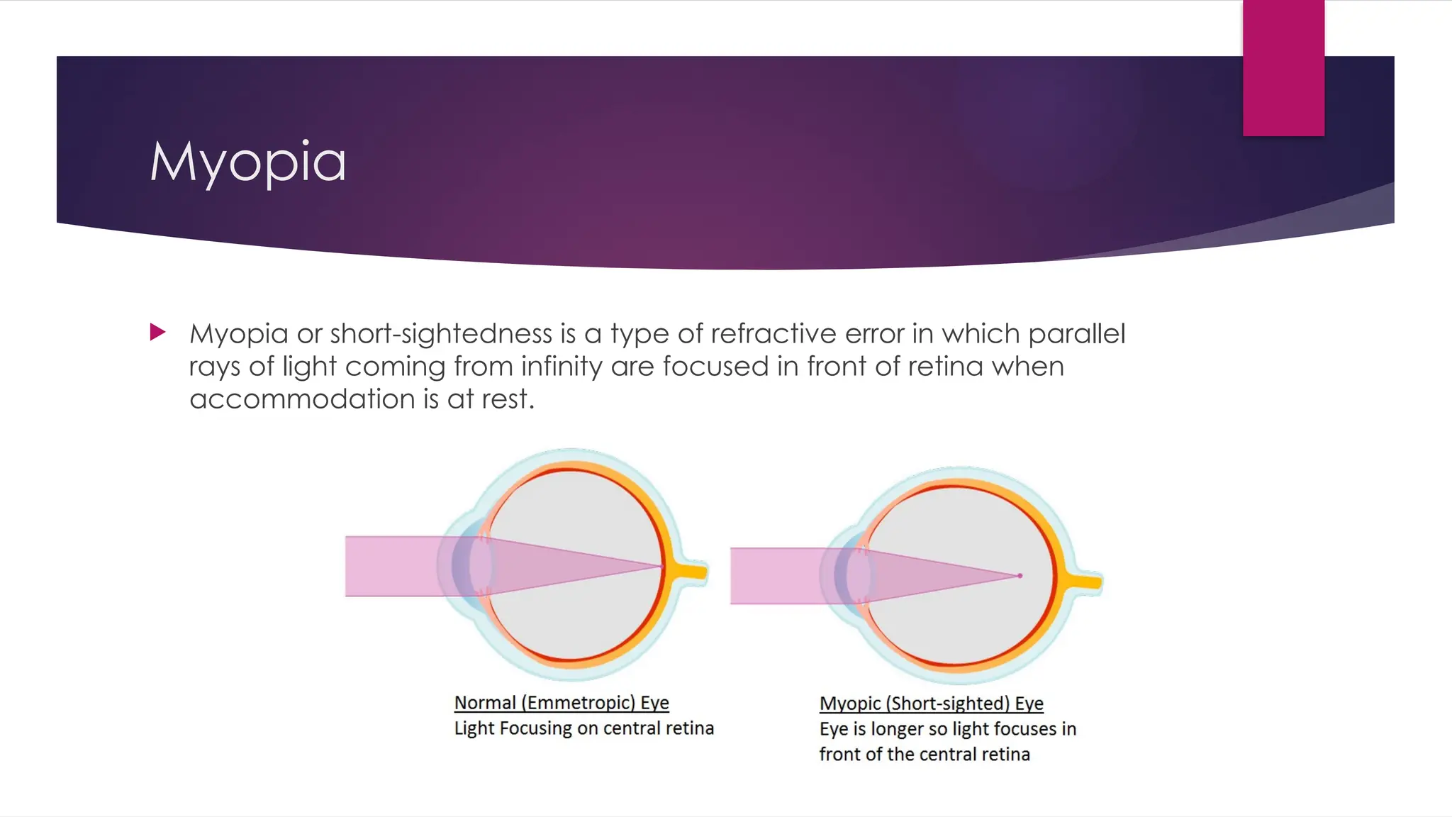Myopia of the eye , opthalmology presentation | PPTX