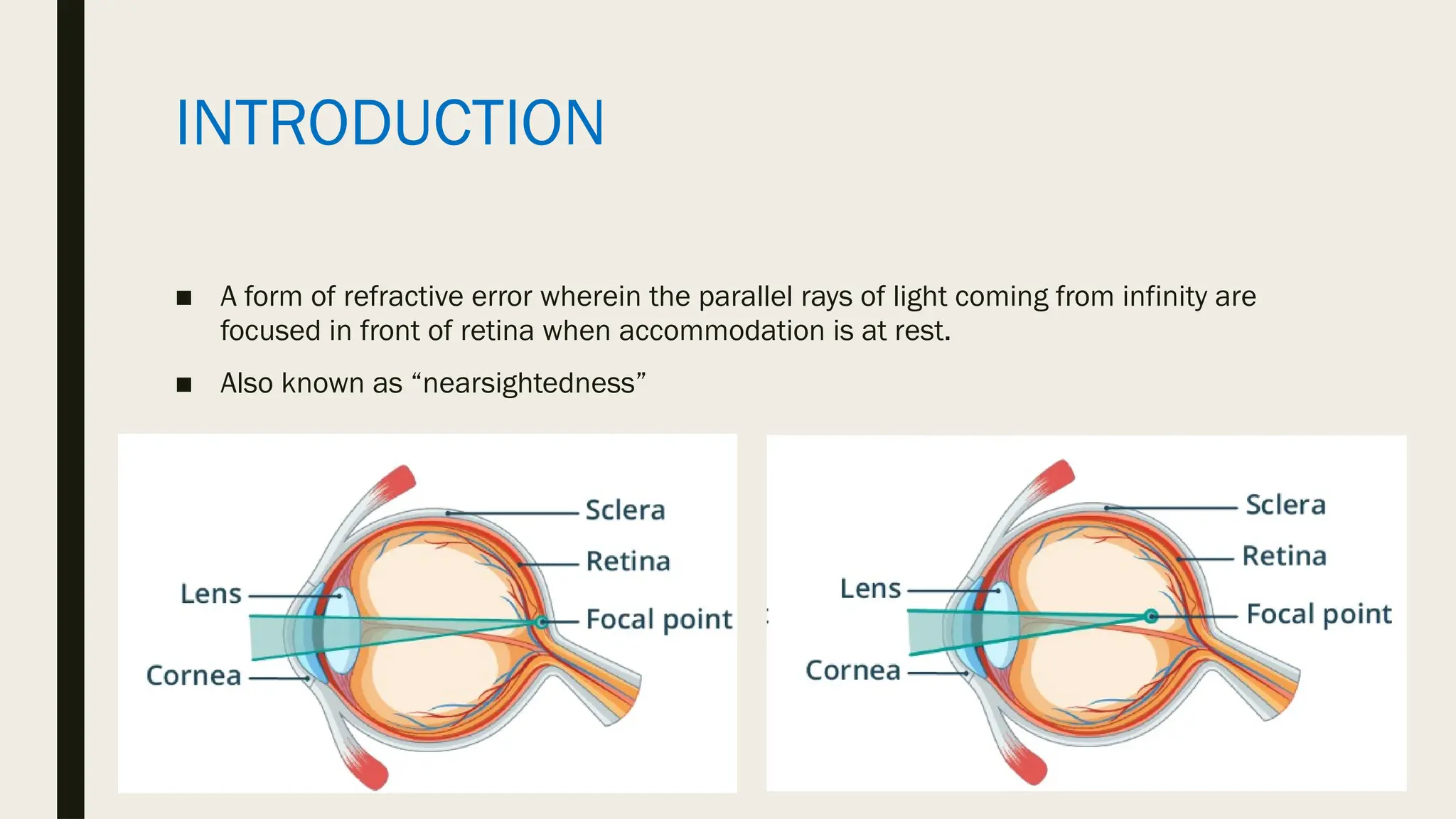 MYOPIA- Refractive error- Dr Sanjana.pptx