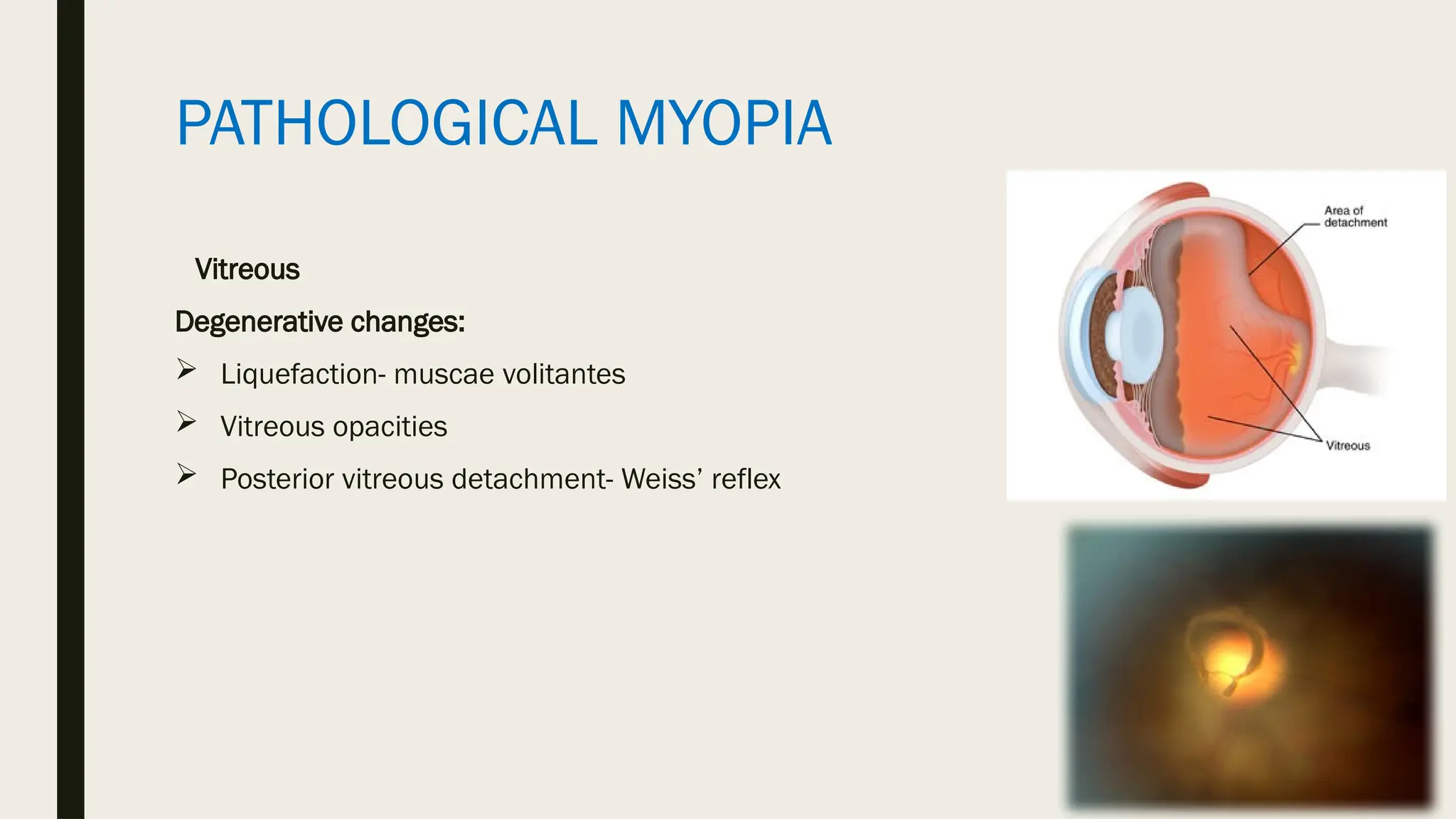 MYOPIA- Refractive error- Dr Sanjana.pptx