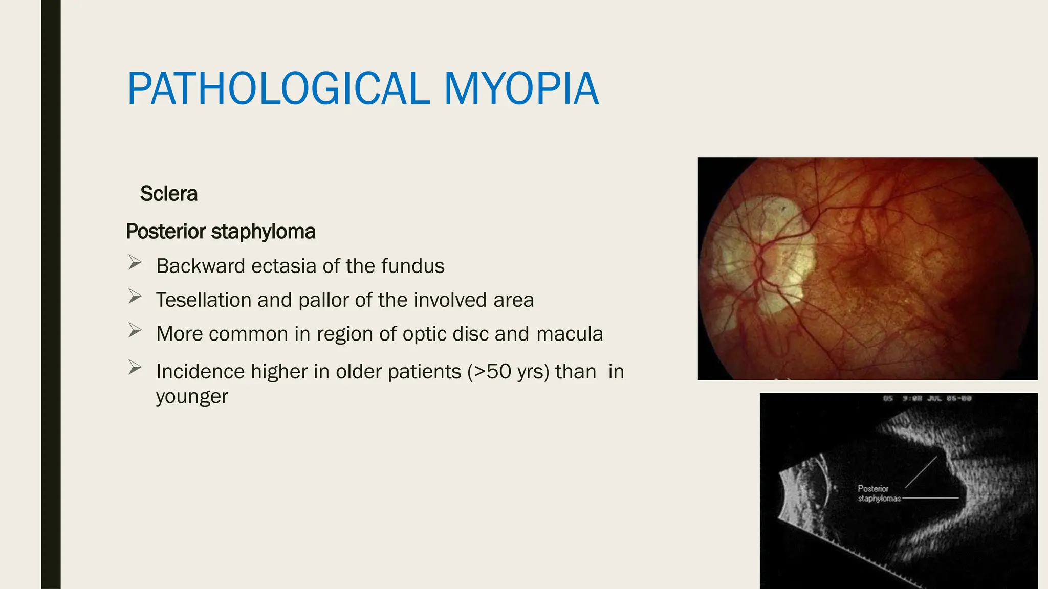 MYOPIA- Refractive error- Dr Sanjana.pptx