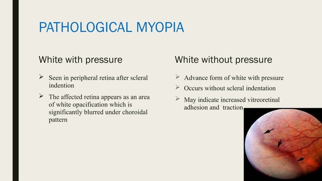 MYOPIA- Refractive error- Dr Sanjana.pptx