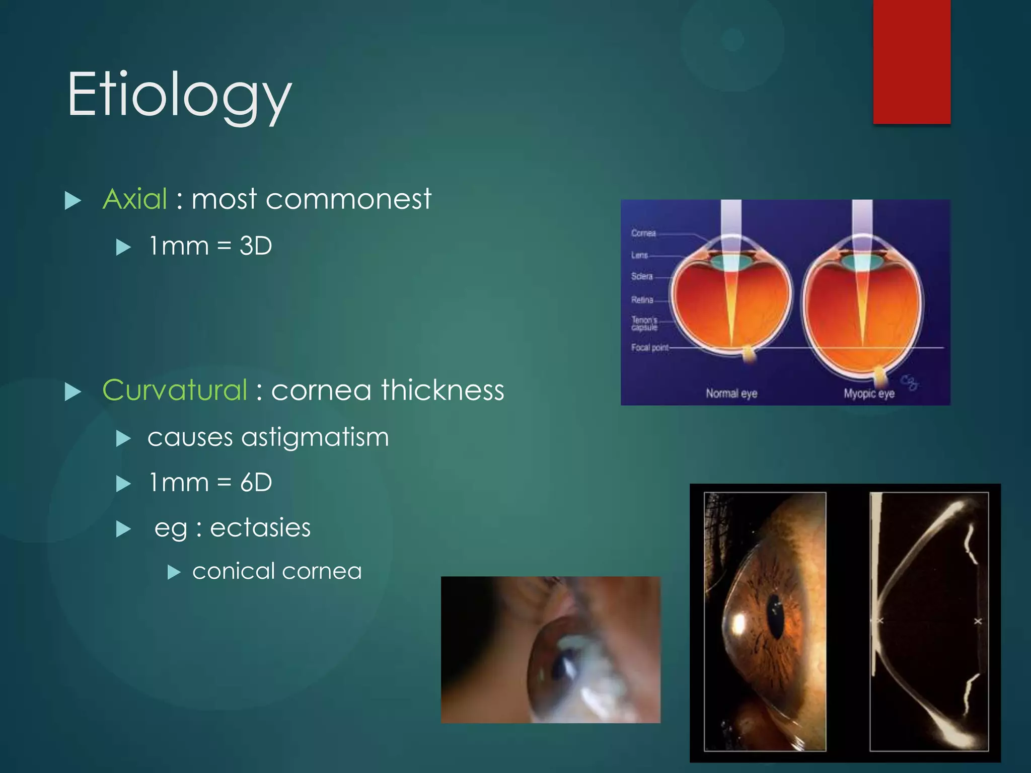 Myopia refractive error-M.B | PPTX