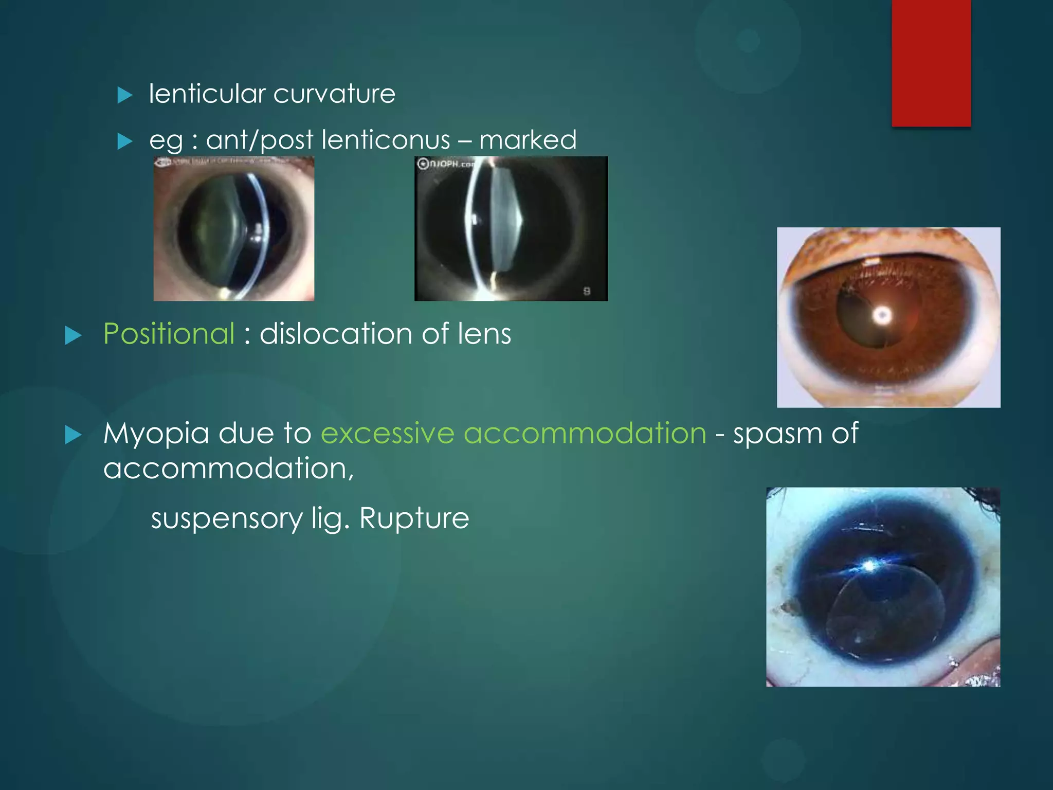 Myopia refractive error-M.B | PPTX