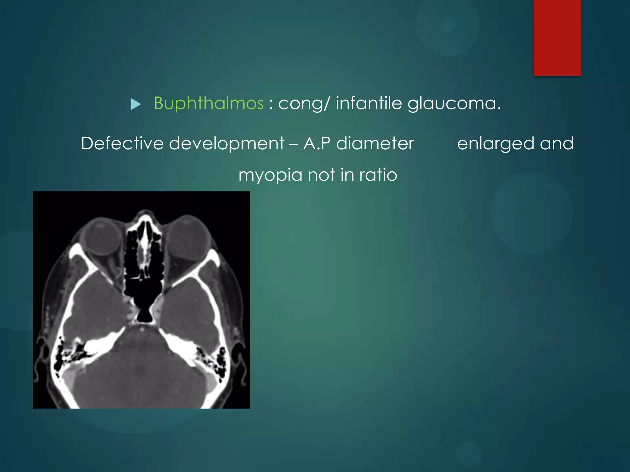 Myopia refractive error-M.B | PPTX