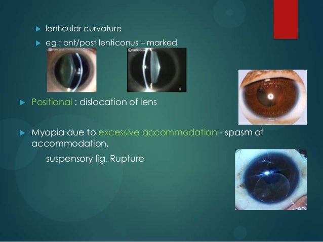 Myopia refractive error