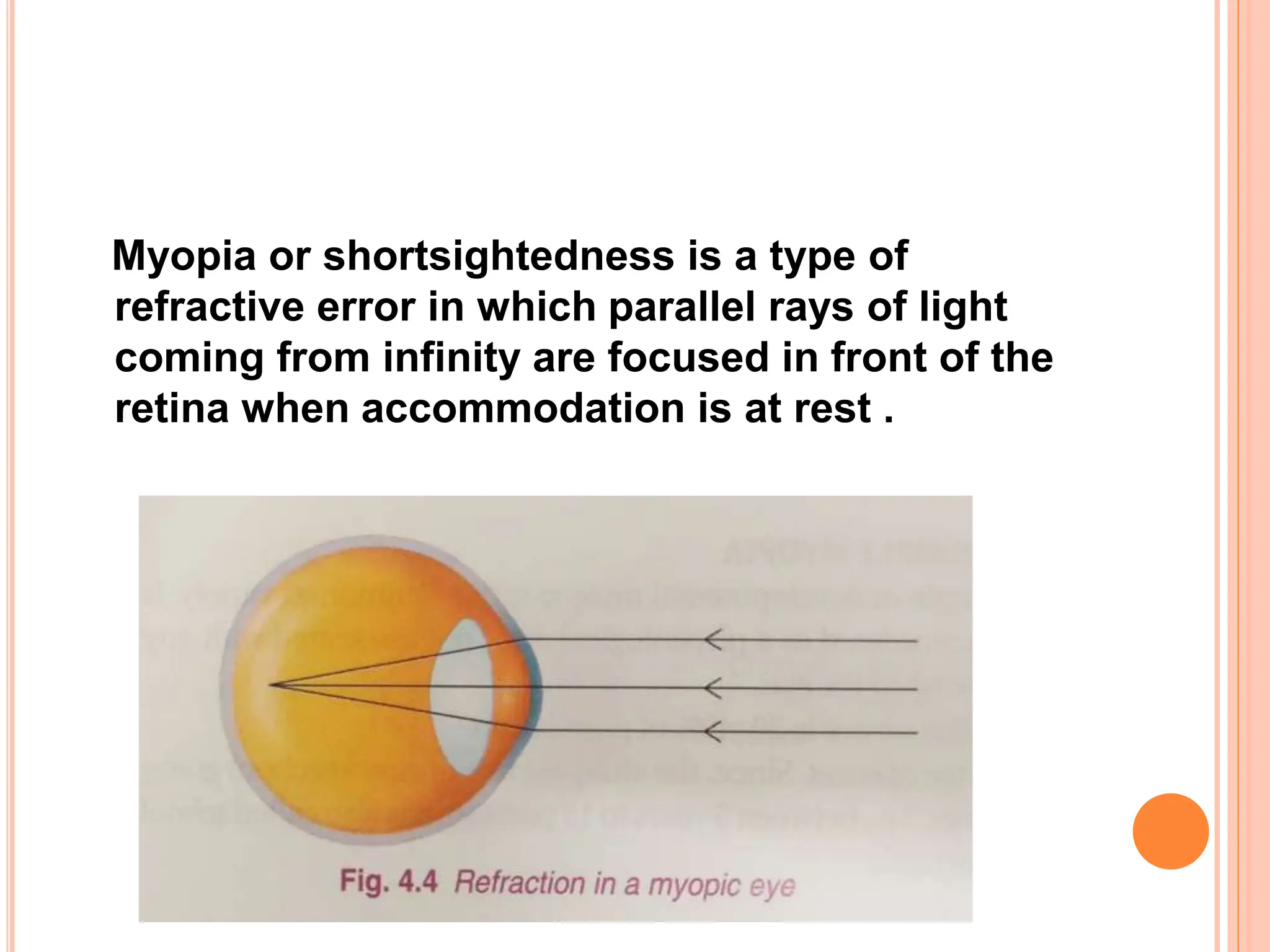myopia 1.pptx Ophthalmology MBBS 3rd year | PPTX