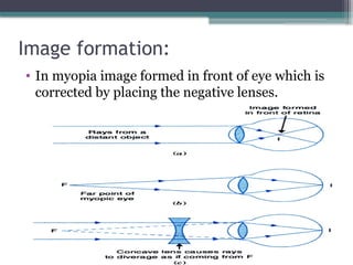 myopia C.pptx . . . . . . . . . . . . | PPT