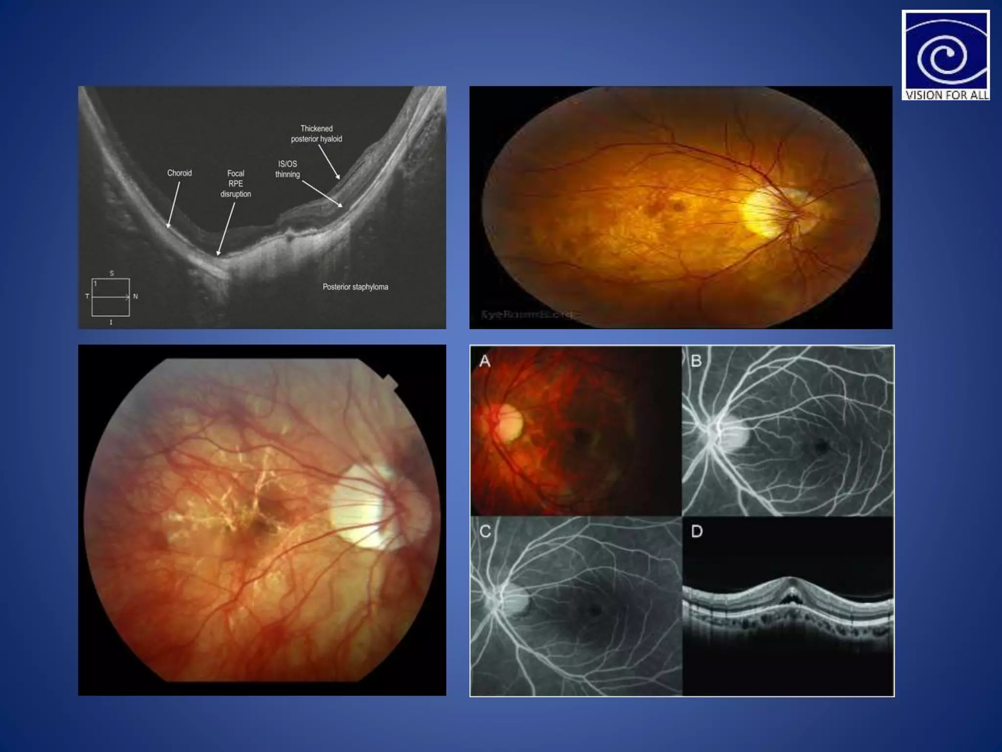 Myopia classification ,prevalence , pathological myopia & its control ...