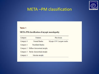 Myopia classification ,prevalence , pathological myopia & its control ...