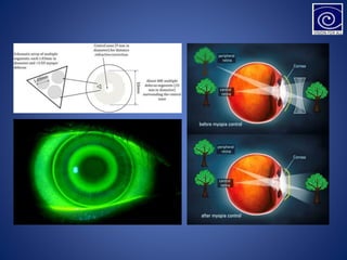 Myopia classification ,prevalence , pathological myopia & its control ...
