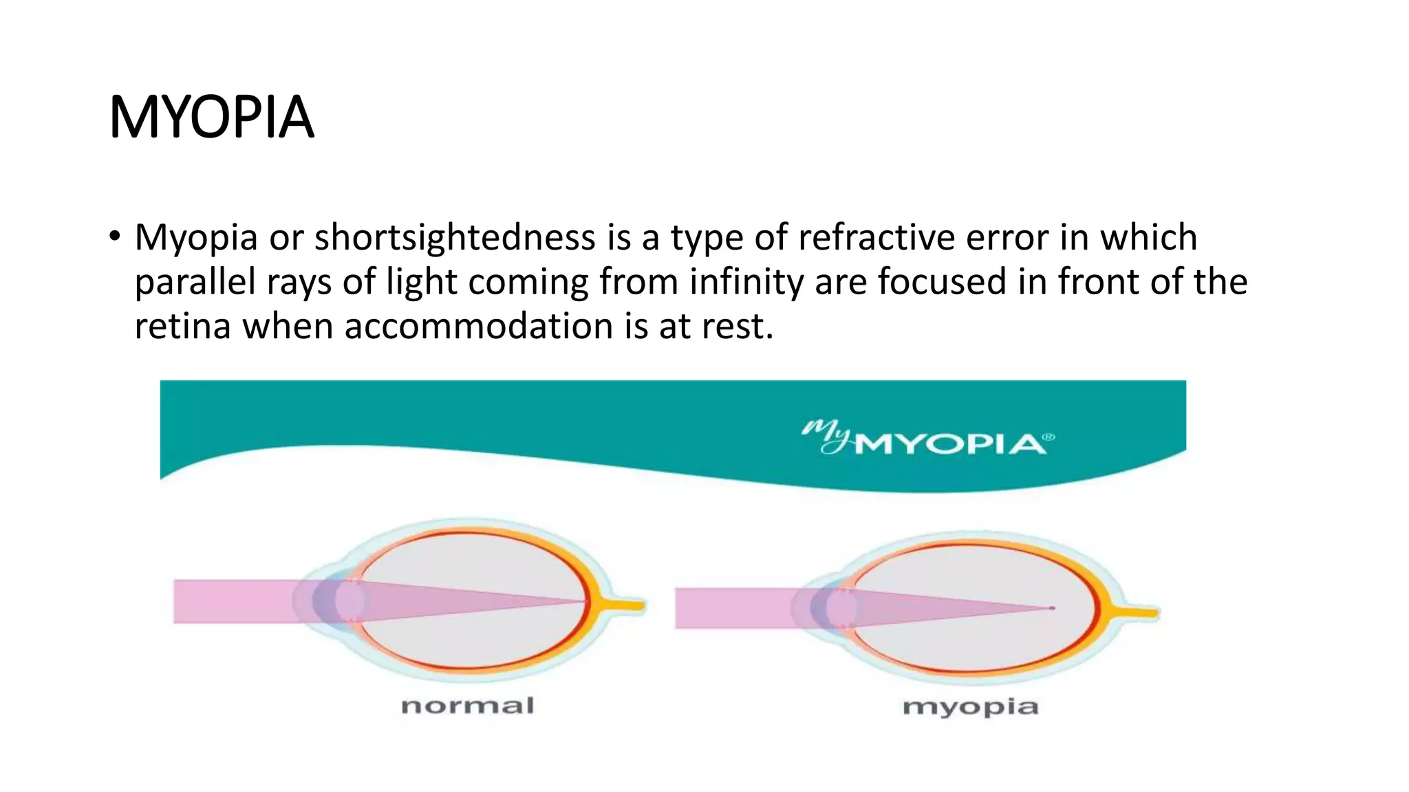 myopia & hypermetropia.pptx
