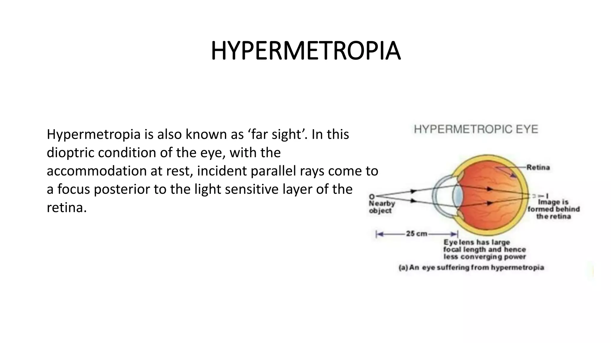 myopia & hypermetropia.pptx