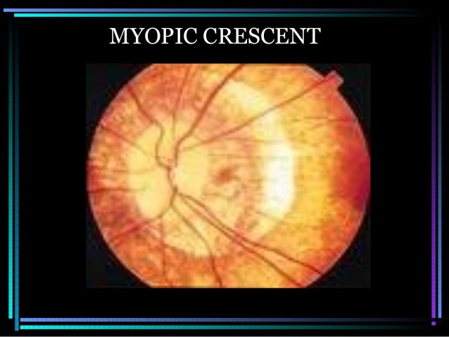 Myopia lecture By Sumayya Naseem