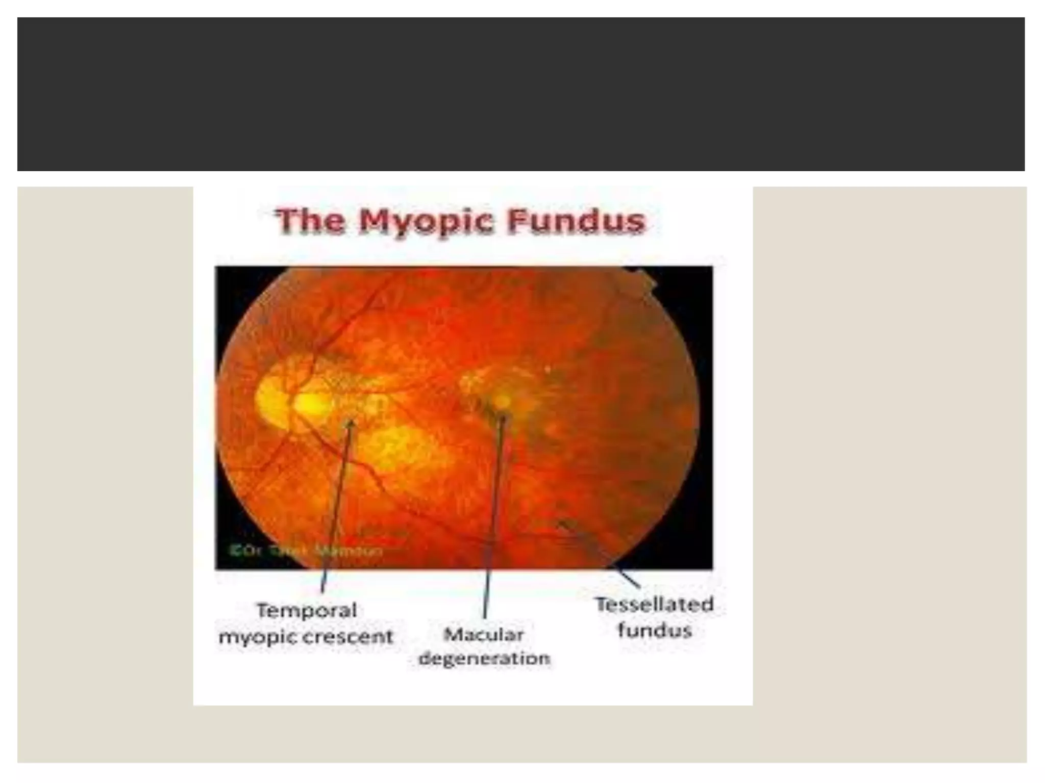 Myopia | PPTX