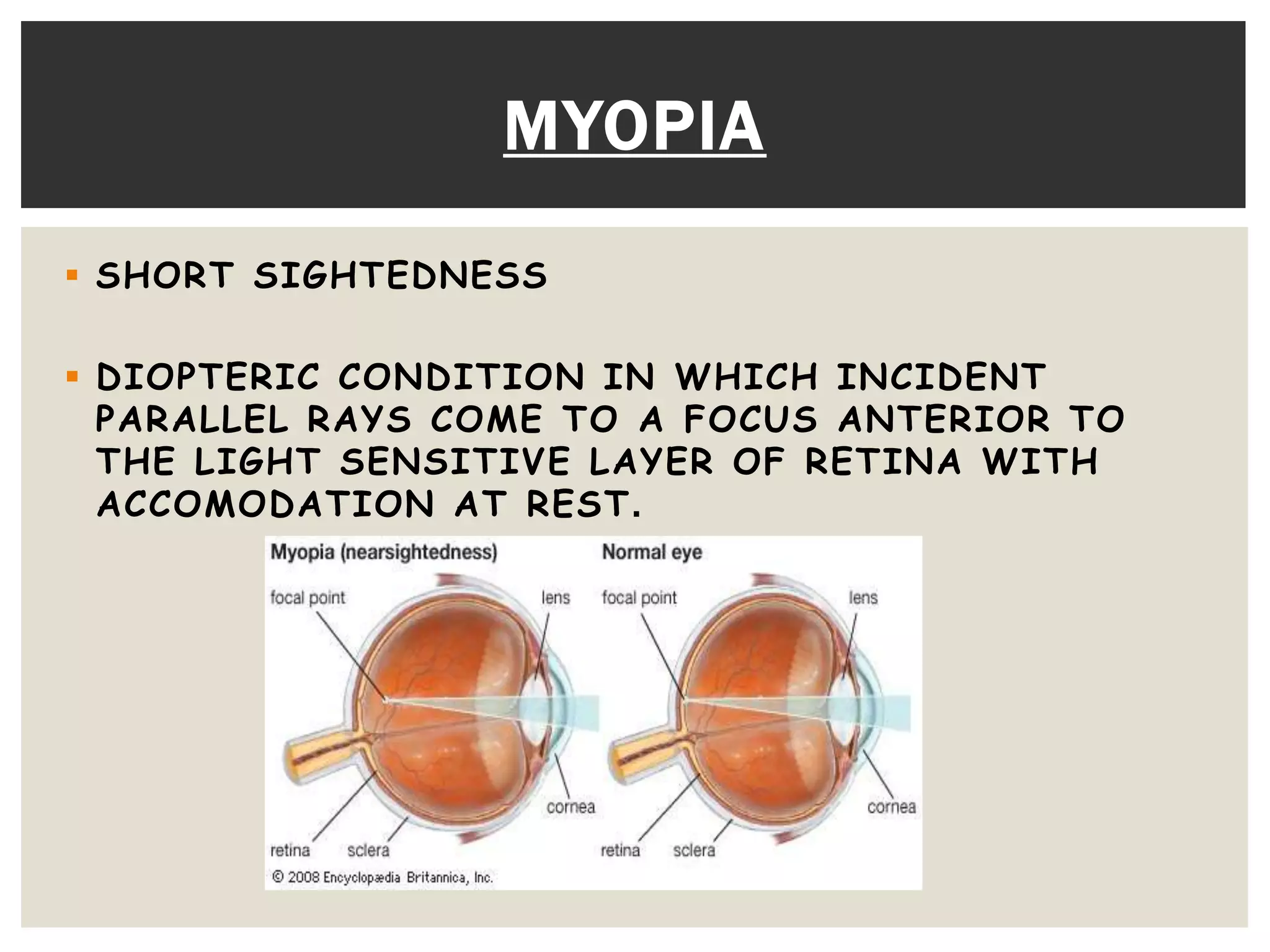 Myopia | PPTX