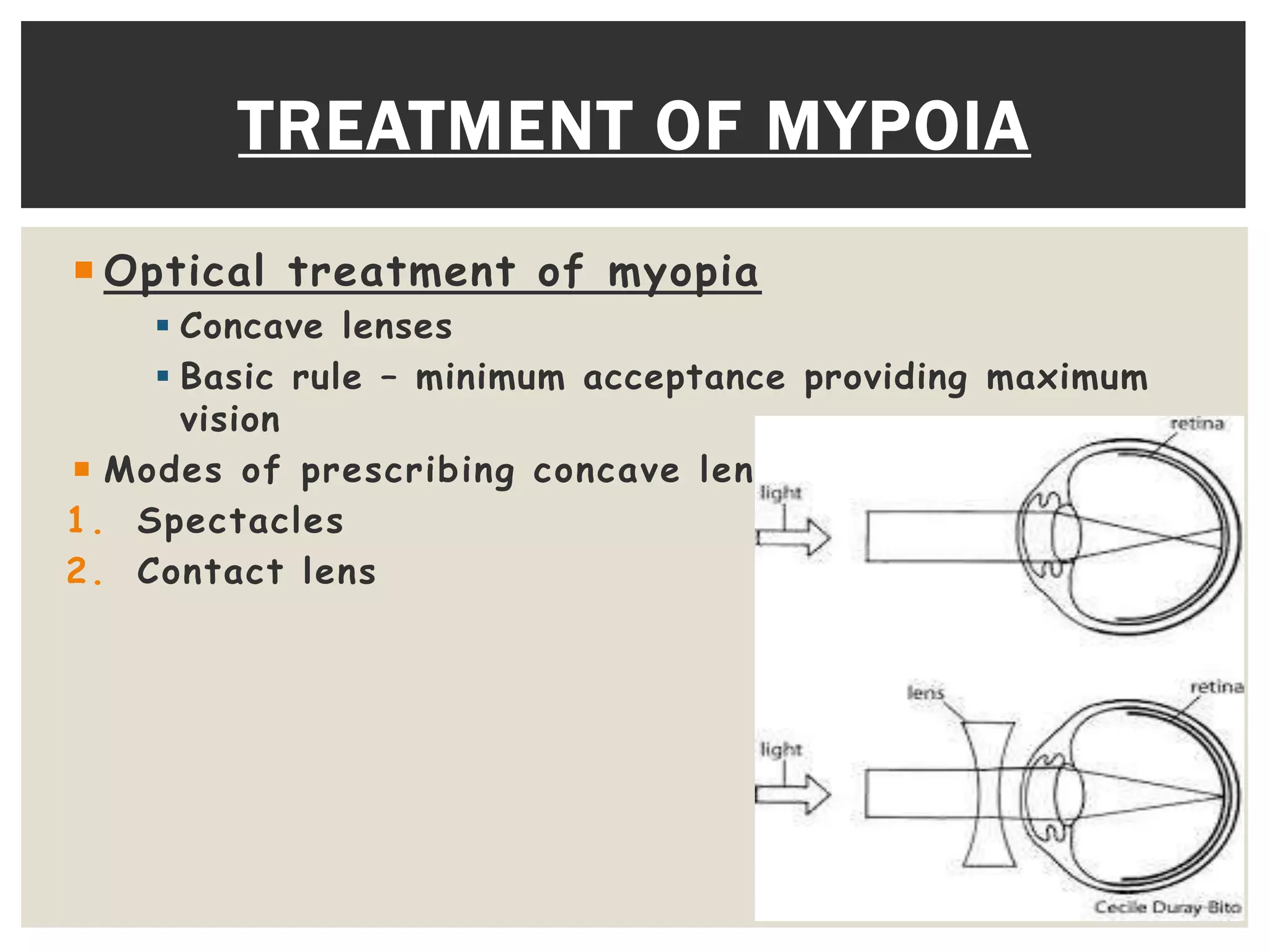 Myopia | PPTX
