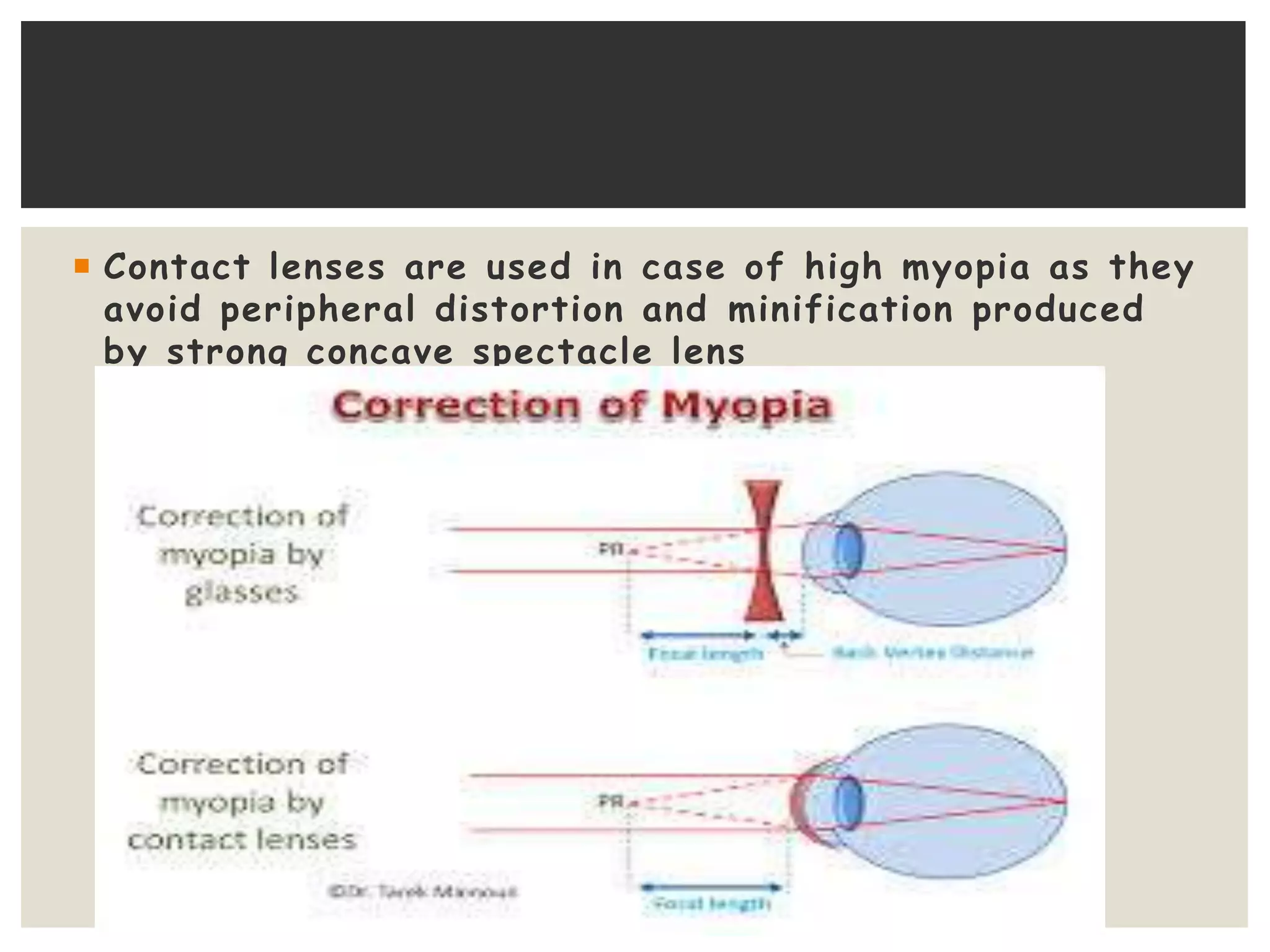 Myopia | PPTX