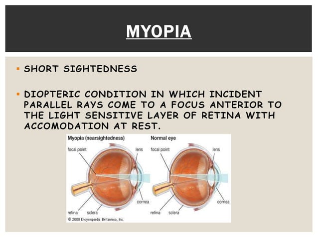 Myopia | PPTX | Eye and Vision Conditions | Diseases and Conditions