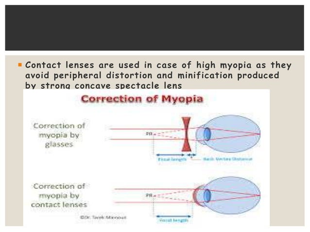 Myopia | PPTX | Eye and Vision Conditions | Diseases and Conditions