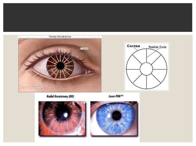 Myopia | PPTX | Eye and Vision Conditions | Diseases and Conditions