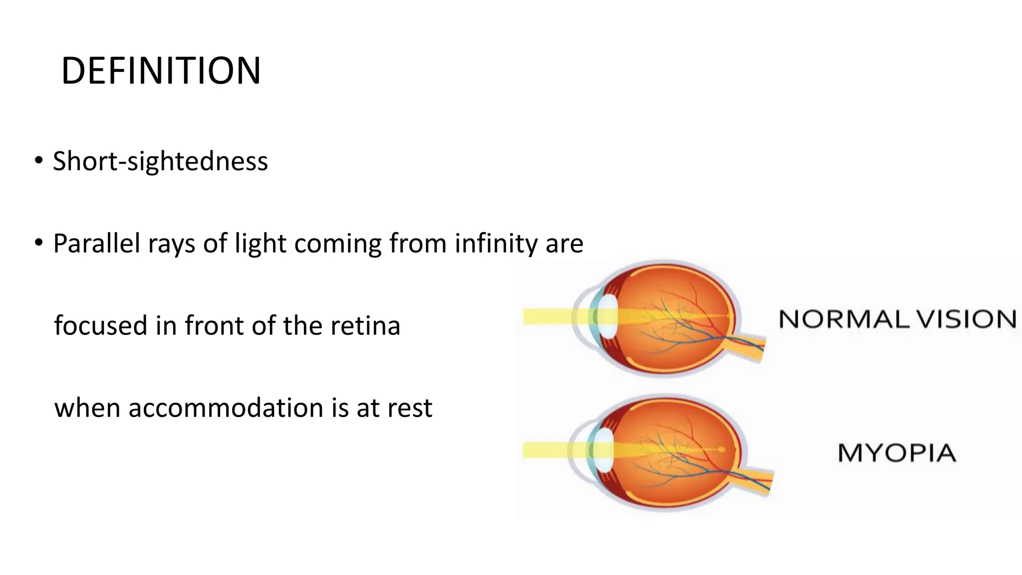 OPHTHALMOLOGY PRESENTATION, TOPIC ON MYOPIA | PPT